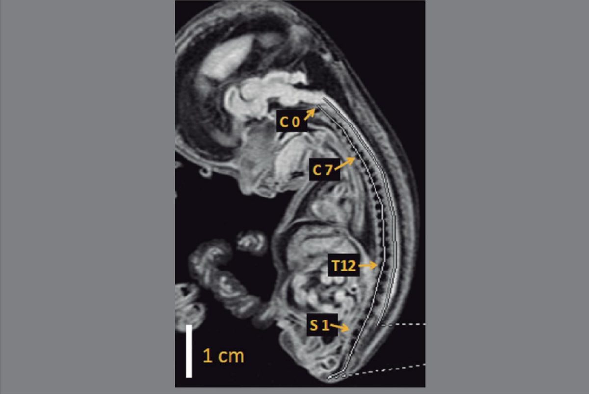 DESENVOLVIMENTO LONGITUDINAL DA COLUNA VERTEBRAL E MEDULA ESPINAL EM ...